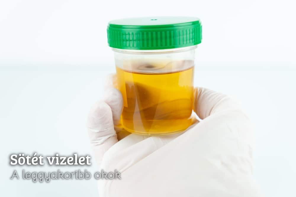 A sötét vizelet okai és mikor jelent problémát? - Prosztata.eu